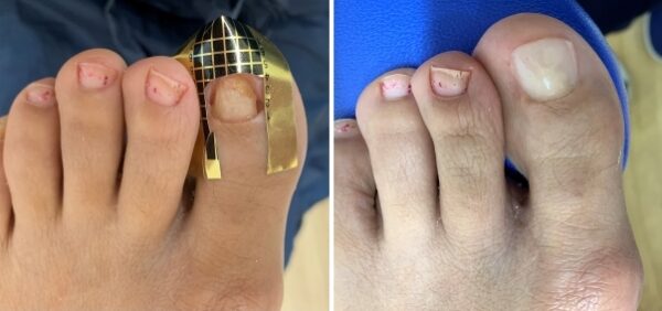 Cosmetic Nail Reconstruction with medical benefits from North London ...